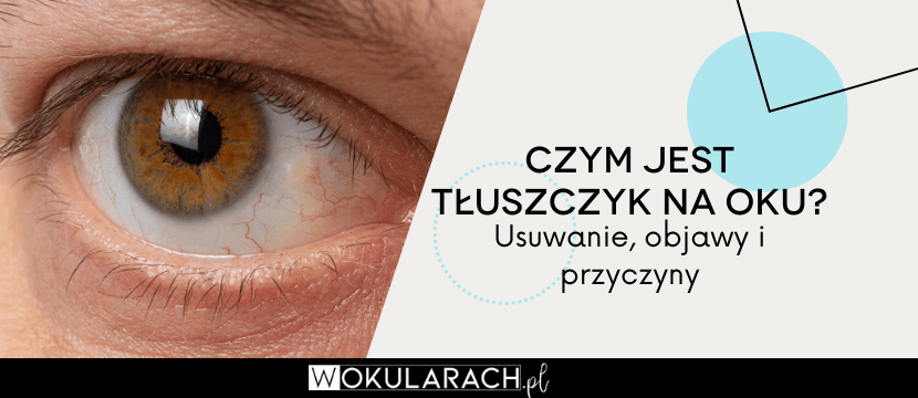 Czym jest tłuszczyk na oku? Usuwanie, objawy i przyczyny | wOkularach.pl